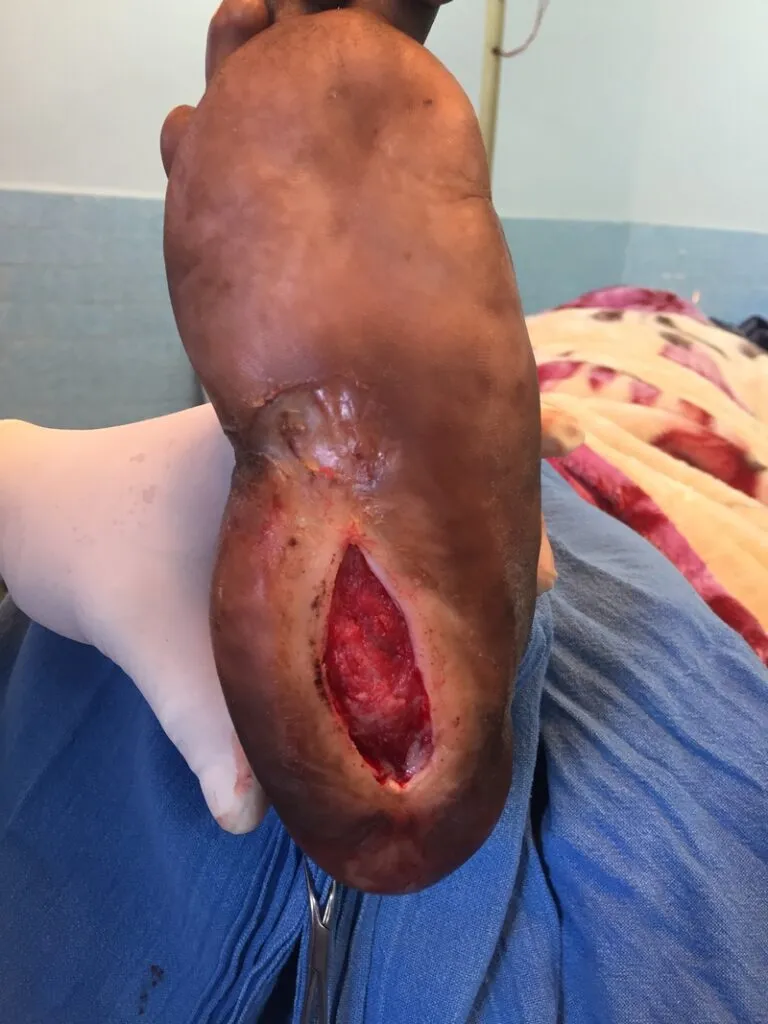 From Despair to Healing: Revolutionary Treatment Transforms Leprosy ...